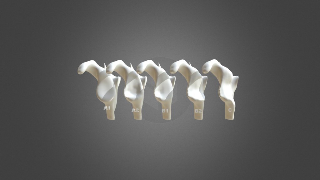 Walch Classification - on test - 3D model by orto3d [a6c0c83] - Sketchfab