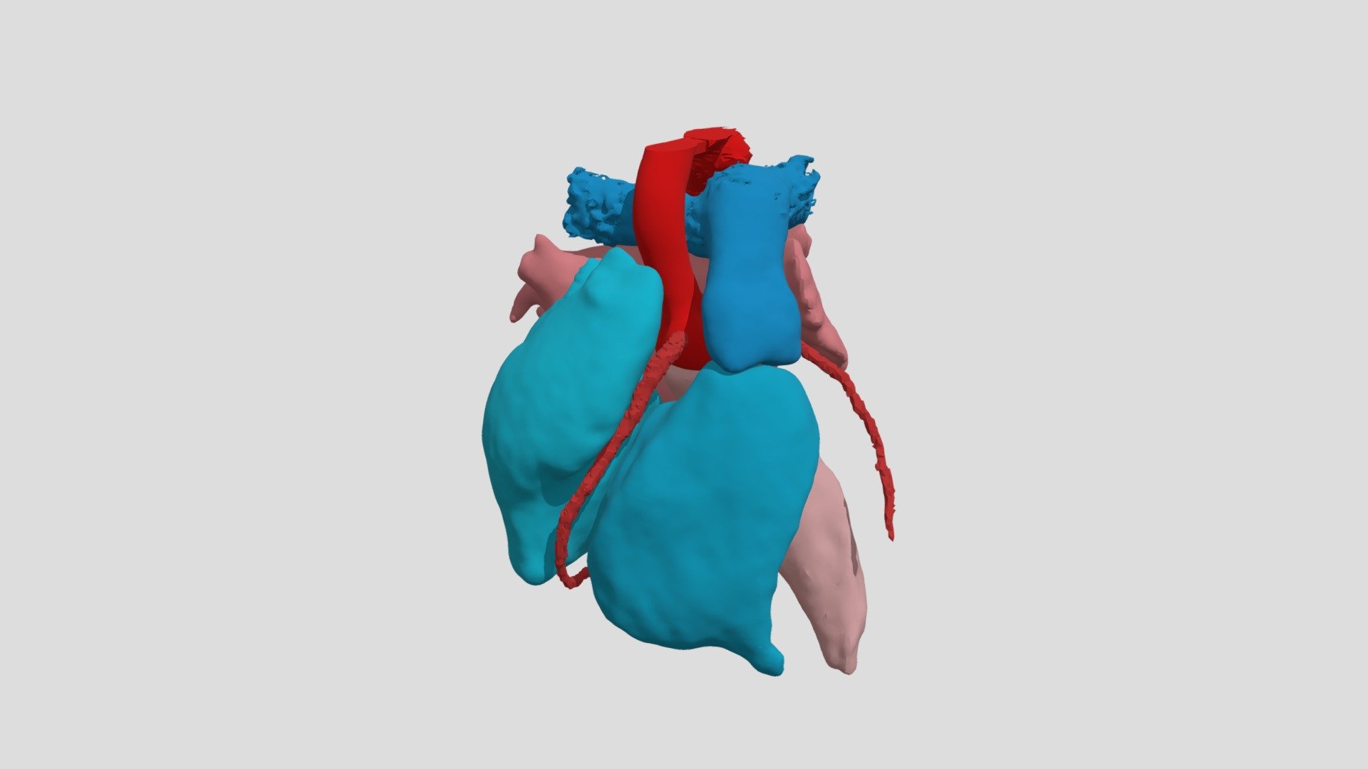 Aortic Valve Stenosis (S0274) - 3D model by NCHS Cardiac Advanced ...