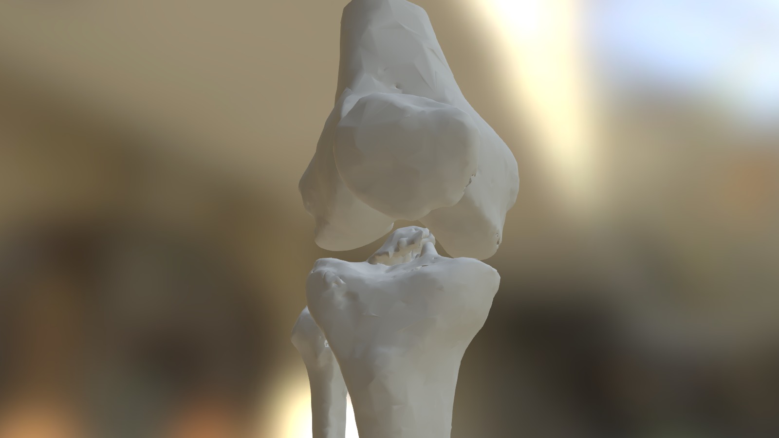 Knee - Proximal Tibia Fracture sku 039 - 3D model by orto3d [a7a6ce2 ...