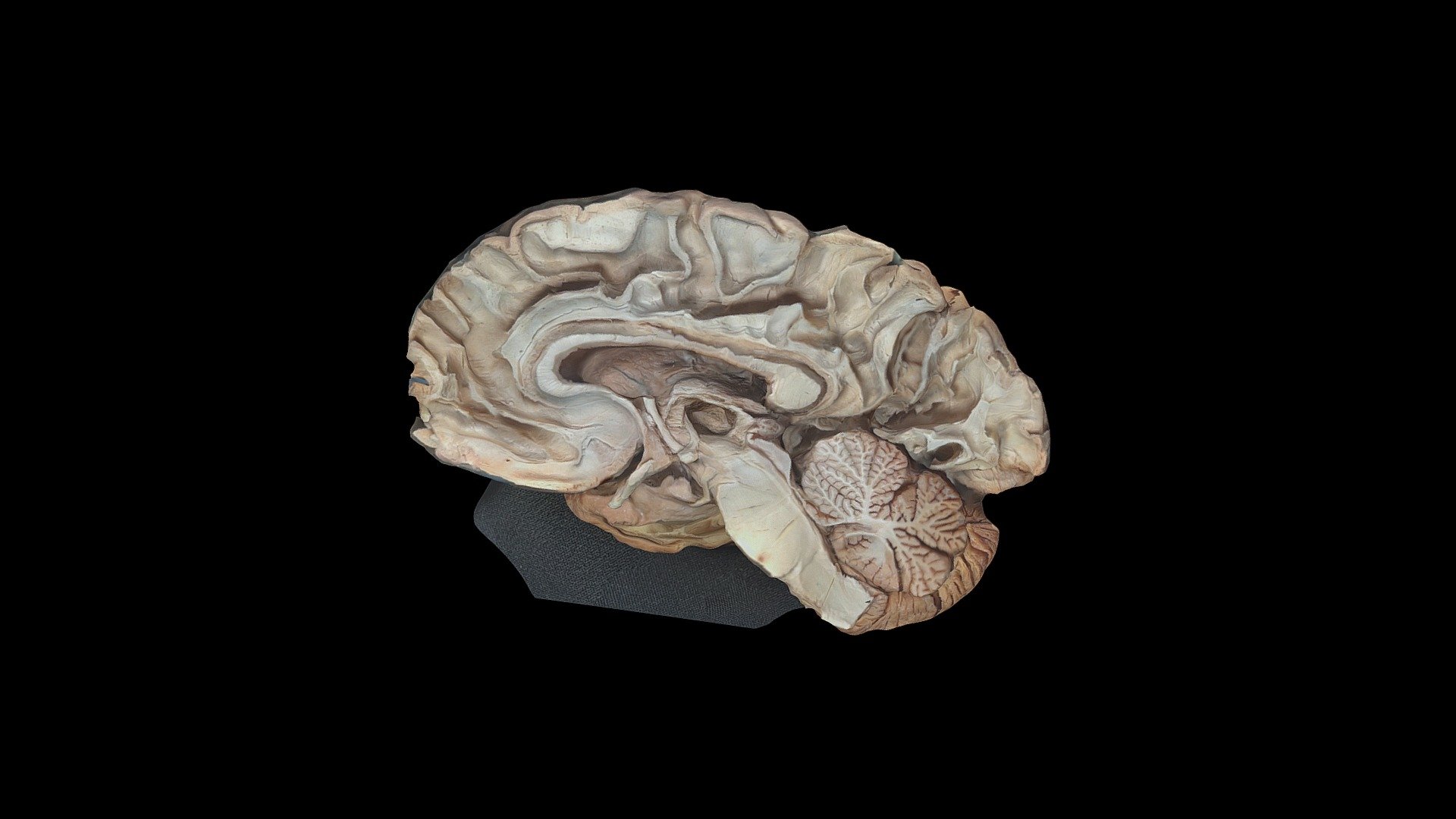 Subthalamic nucleus (medial) - 3D model by Istanbul-Microneurosurgery ...