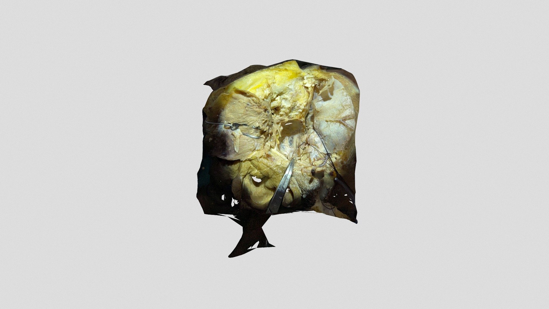 Anterolateral space (Meckel's cave) - 3D model by Neurosurgeon93 ...