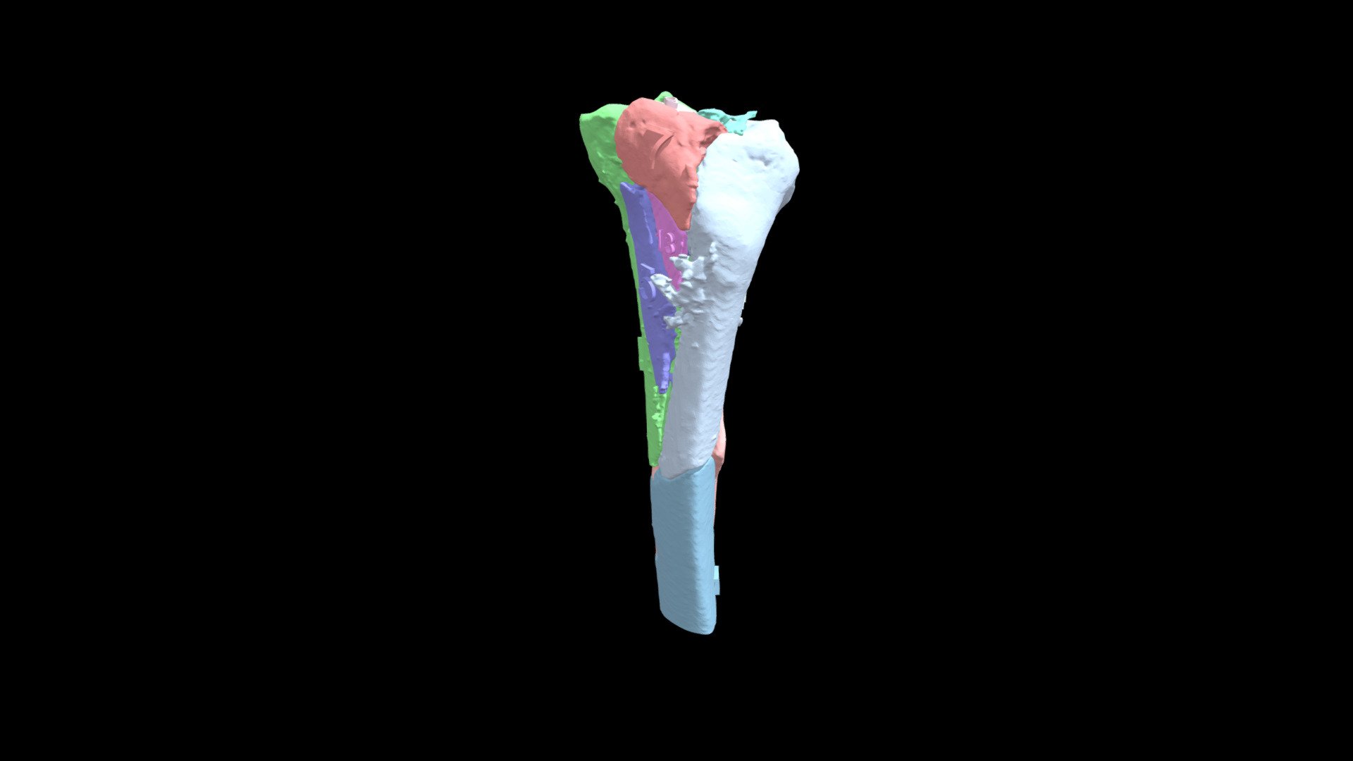 10076110_fractura_platell_tibial - 3D model by Hospital Verge de la ...