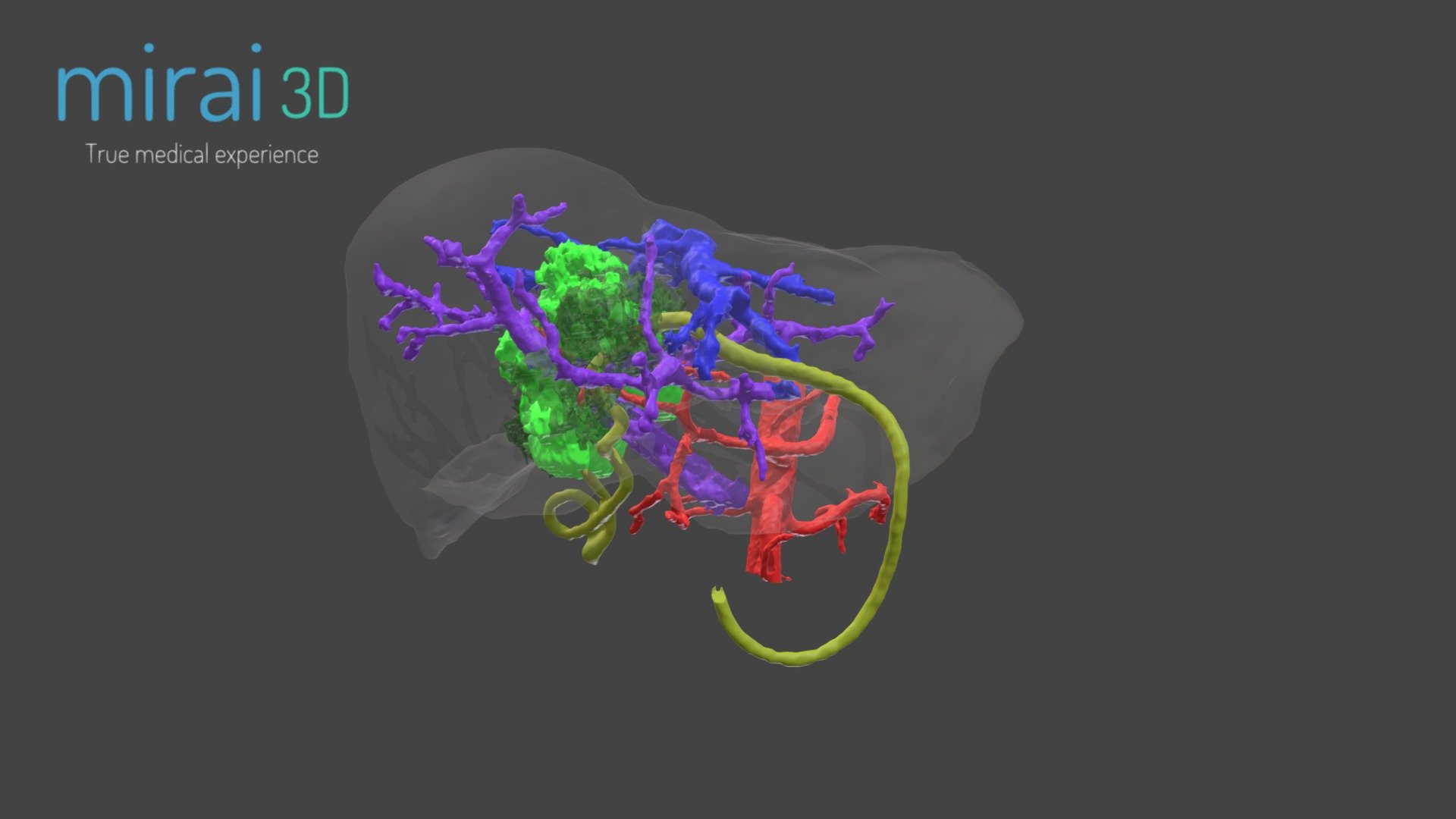 Patient-specific liver anatomical model - 3D model by MIRAI3D [a9b2714 ...