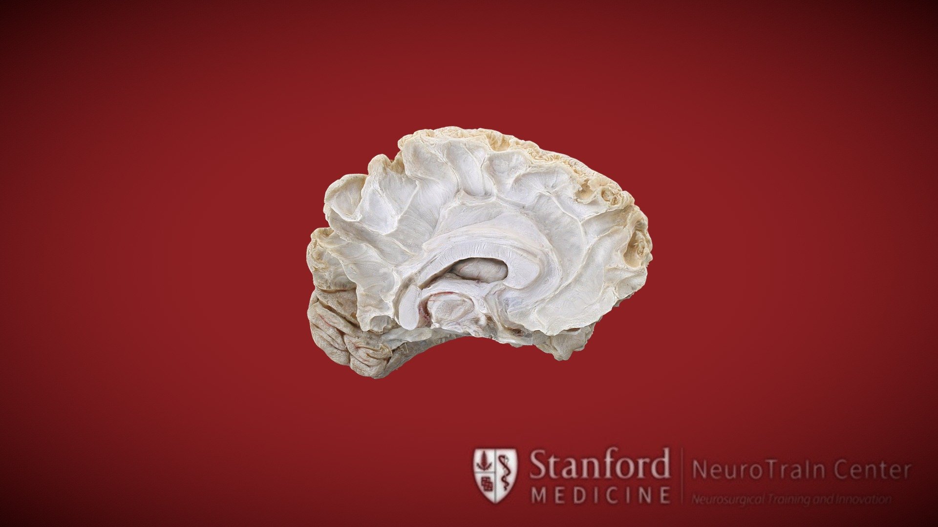 Cingulum and SLF1 Fasciculus - 3D model by vv (@verav) [a9e7421 ...