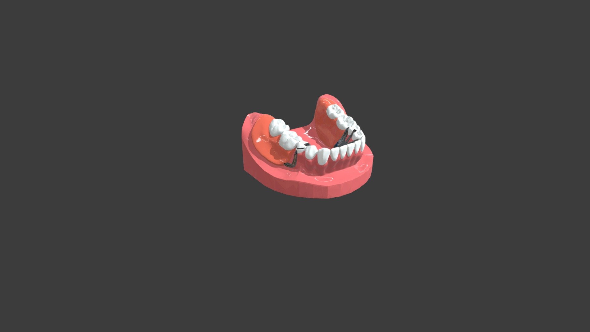 Mandibular RPD Together - 3D model by Ahmed Mahrous (@drahedmahrous ...