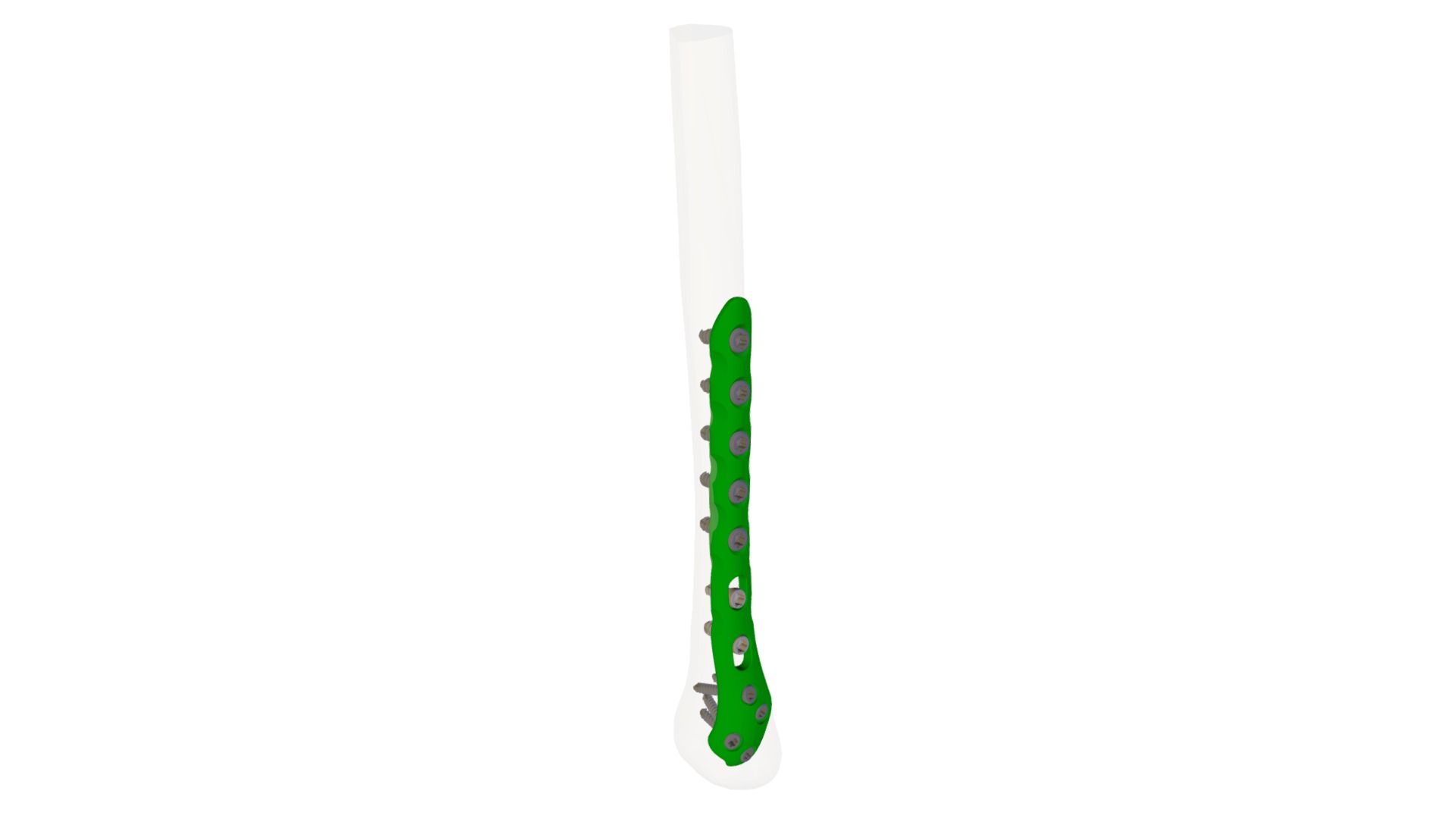 DFIB with Fibula - 3D model by OIC [aa0cf60] - Sketchfab