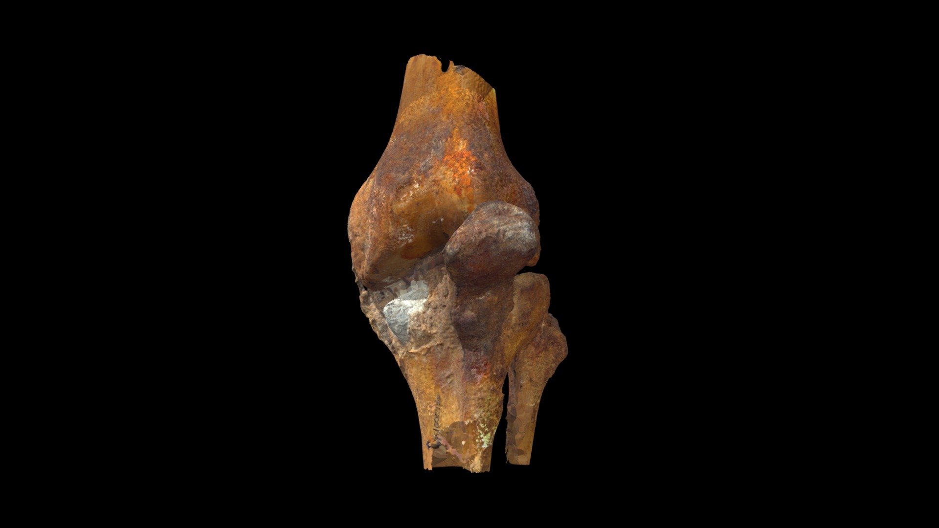 L. Knee with Embedded Bullet (VCU_3D_3188) - 3D model by Virtual ...