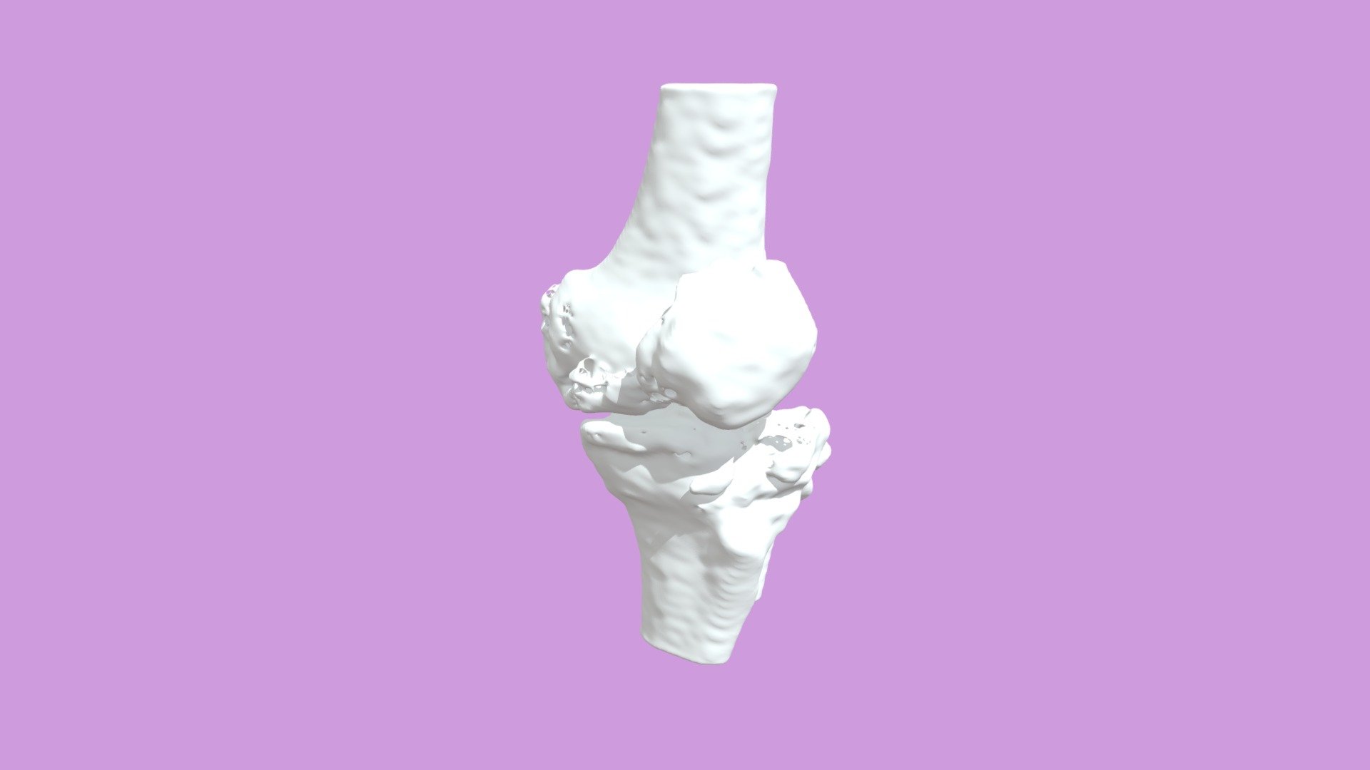 Segmentation Dp Lt Postop - 3D model by curisdata.science [aa69004 ...