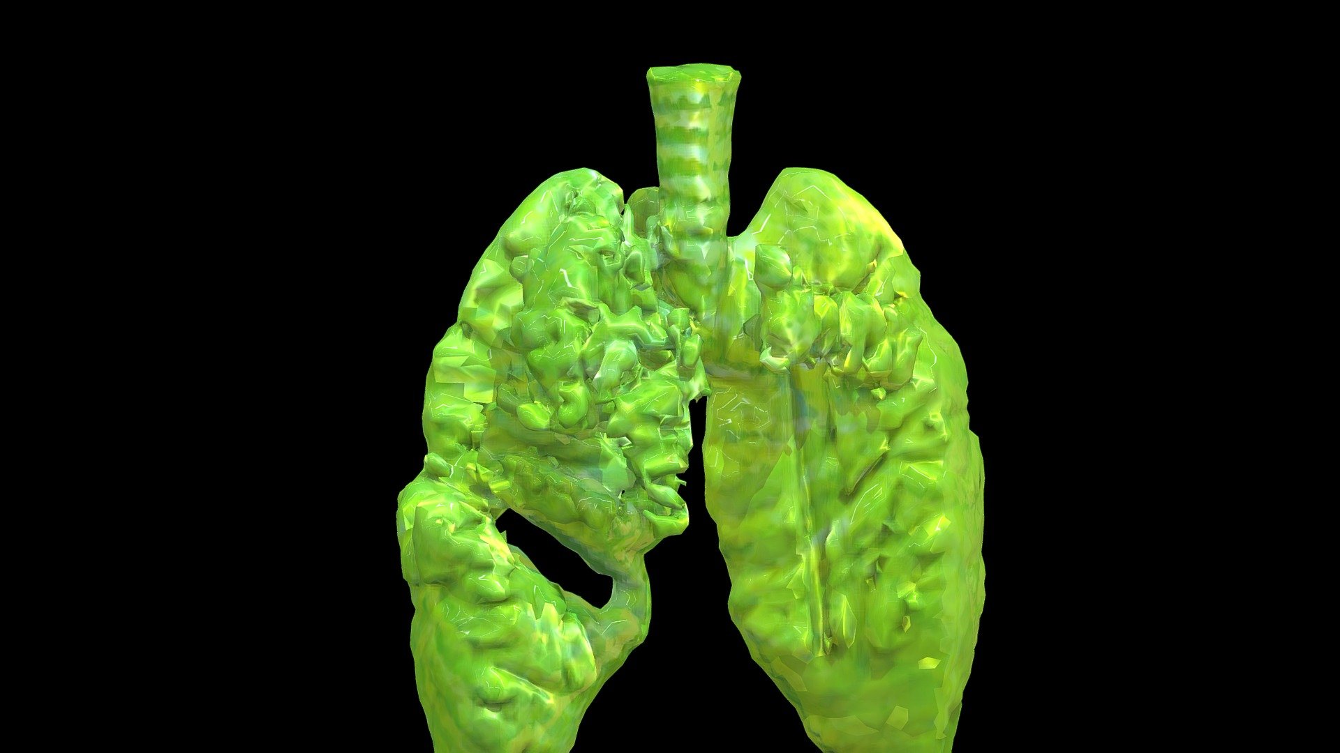 3d_tuberculosis_0422064947_obj - 3D model by hensondefault [aa807eb ...