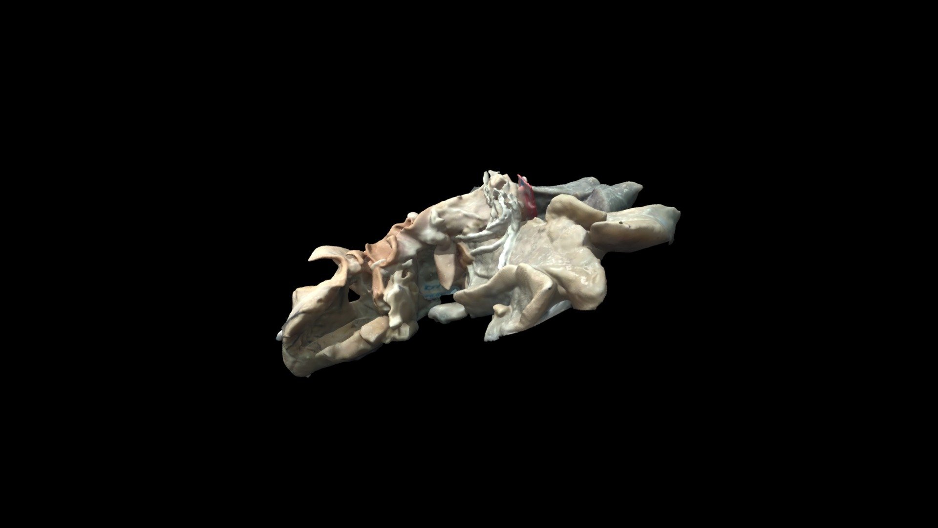 Atrioventricular septal defect I-449 - 3D model by Rohit Loomba ...