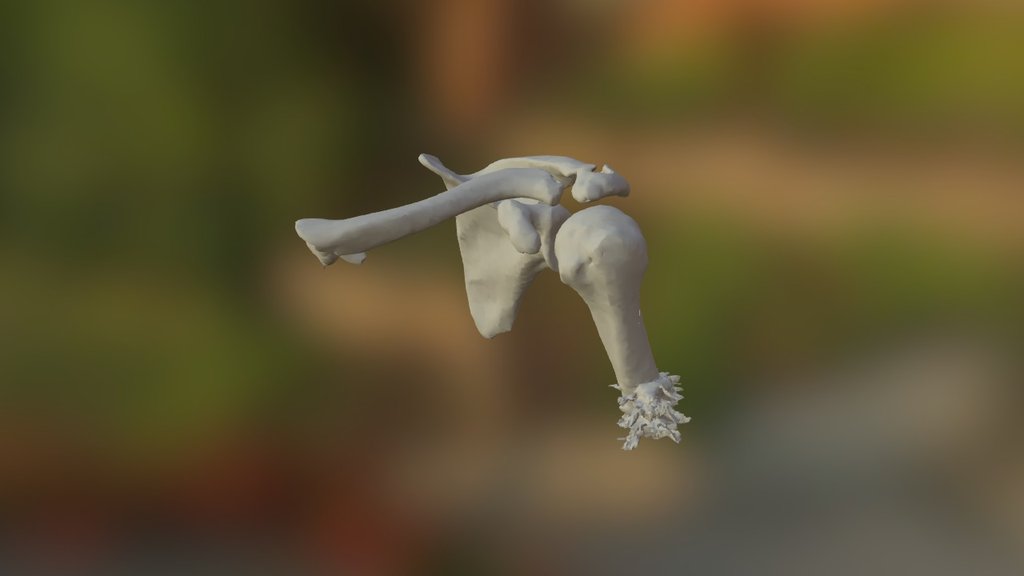 Shoulder Clavicle Fracture - sku315 - 3D model by orto3d [acde3ad ...