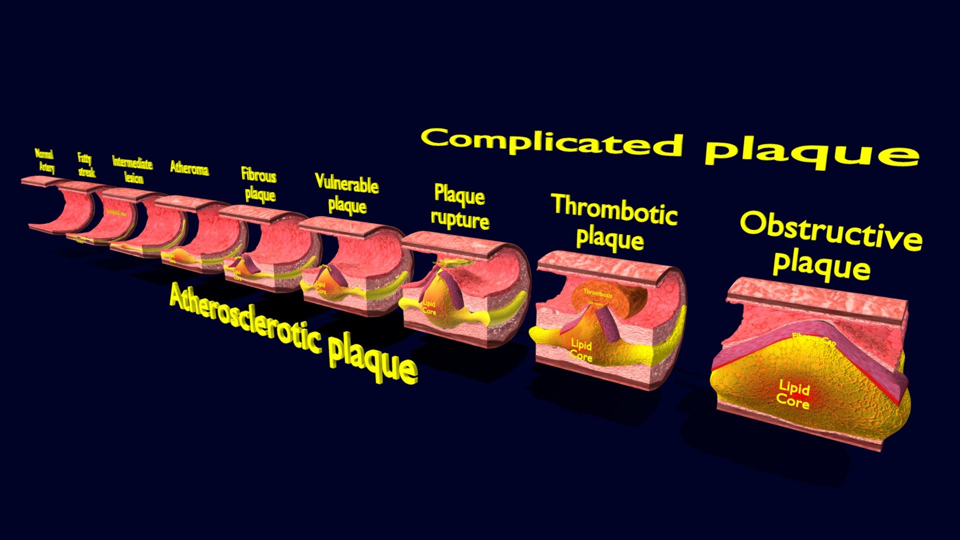 Artery Atherosclerosis plaque and consequences - Buy Royalty Free 3D ...