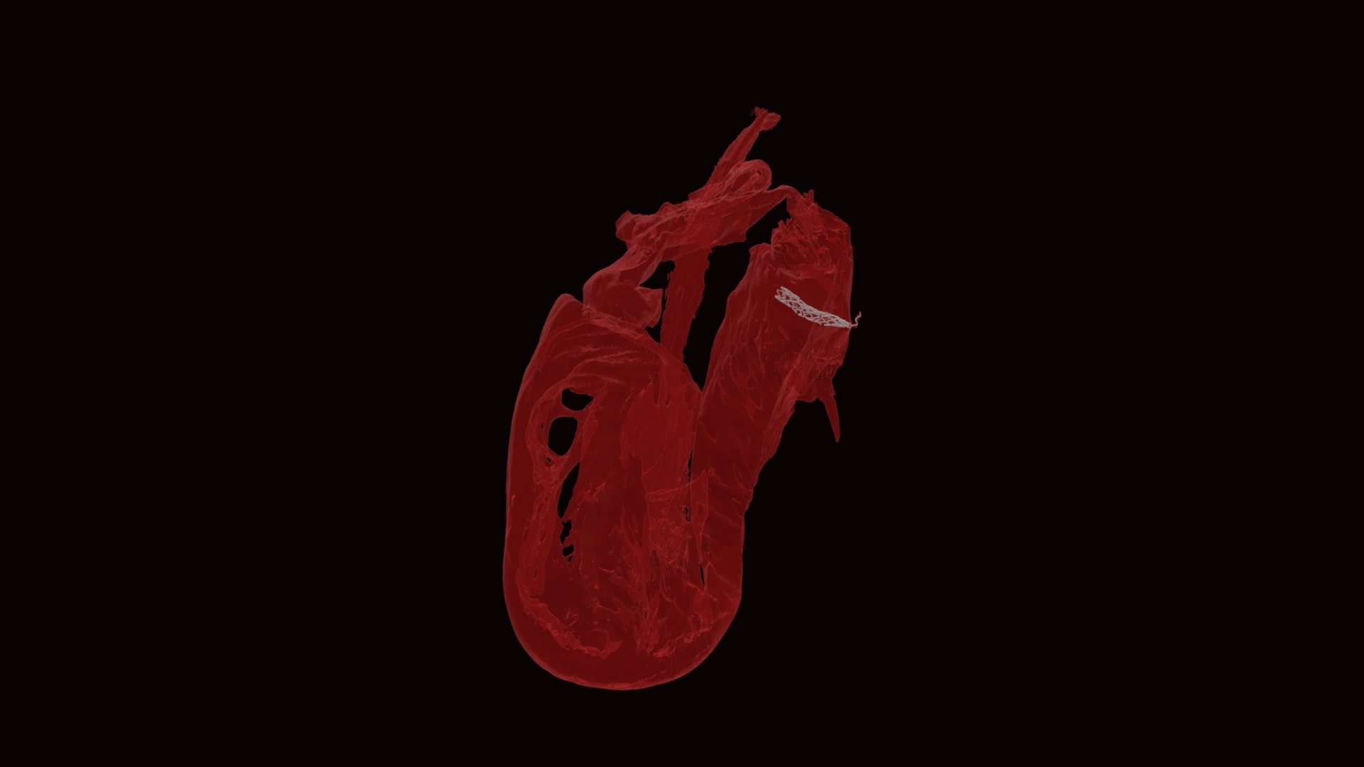 Heart0233, Heart Slice with a Stent - Download Free 3D model by VisibleHeartLabs [ad6baf0 ...