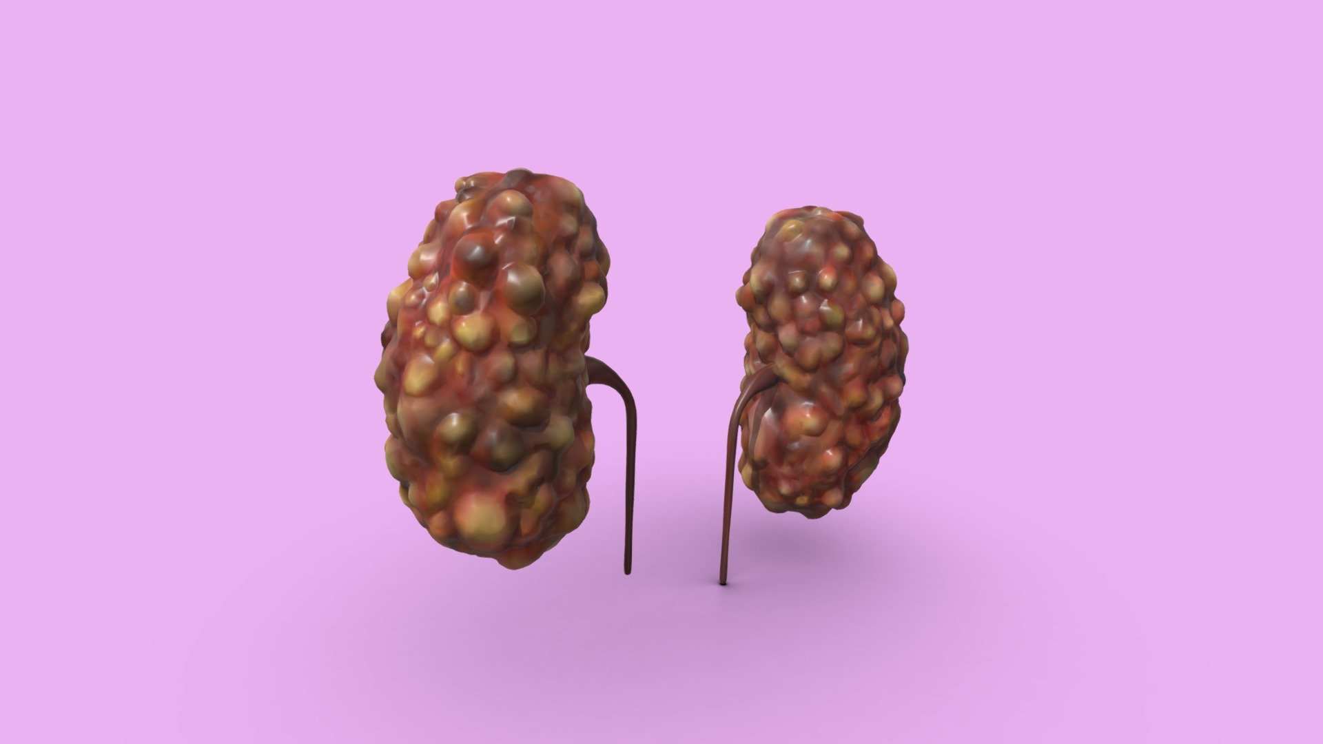 Polycystic kidney - Buy Royalty Free 3D model by PARSONSARTS ...