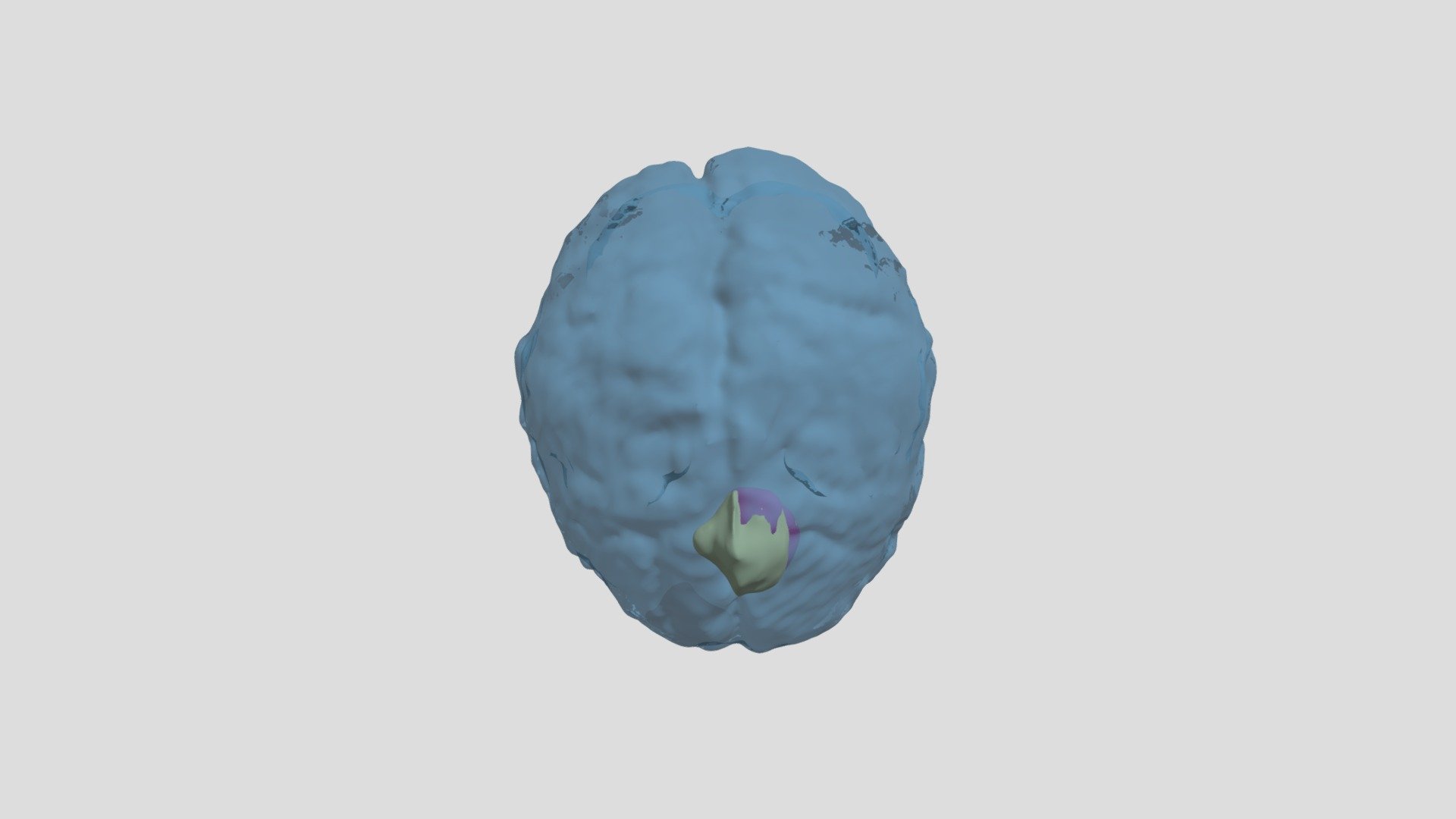 Brain Tumor - 3D model by rlagreca [ad8835d] - Sketchfab