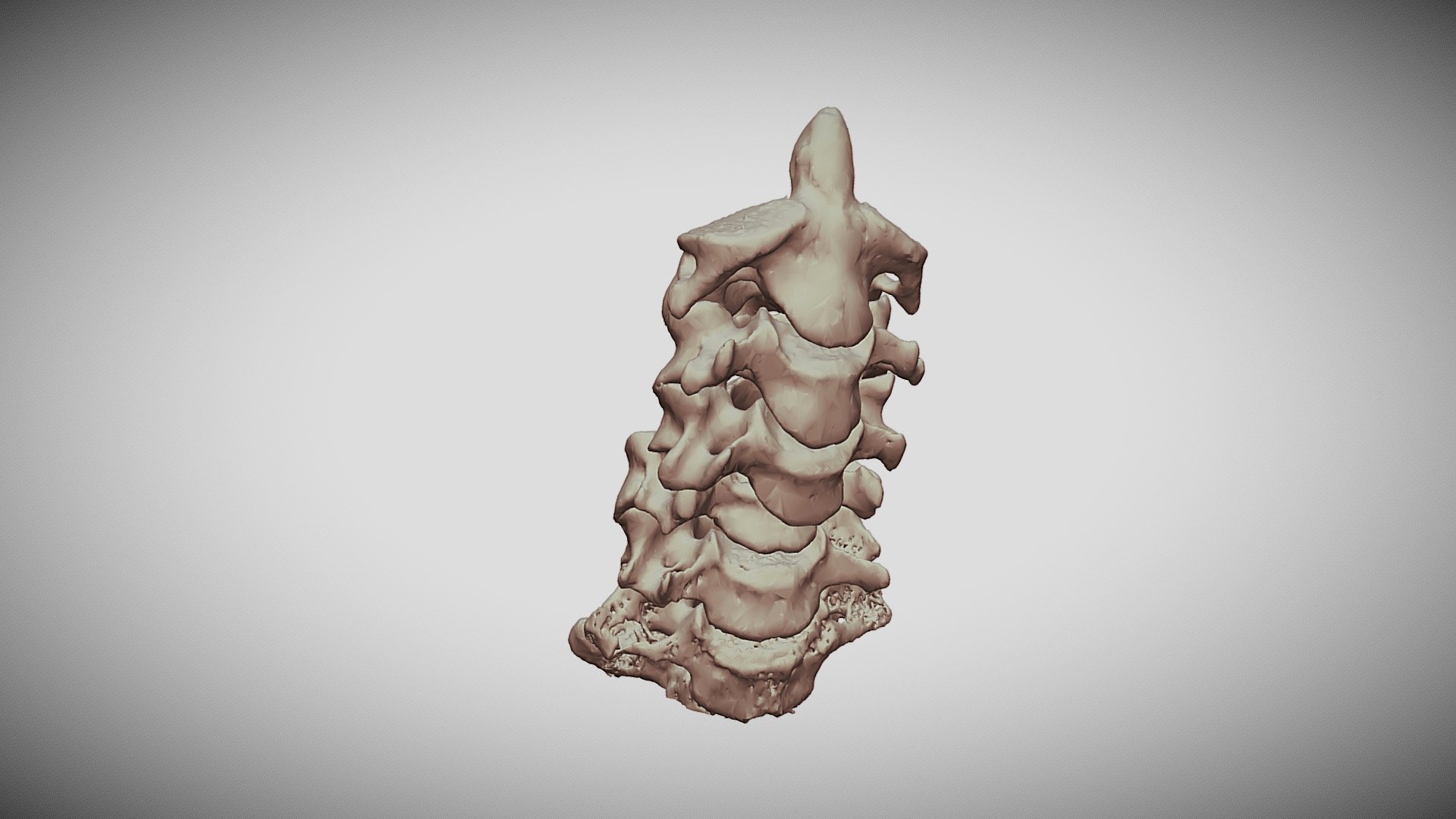 AOspine_Subaxial_TypeC_C4 - 3D model by E_Schulz [ada0777] - Sketchfab