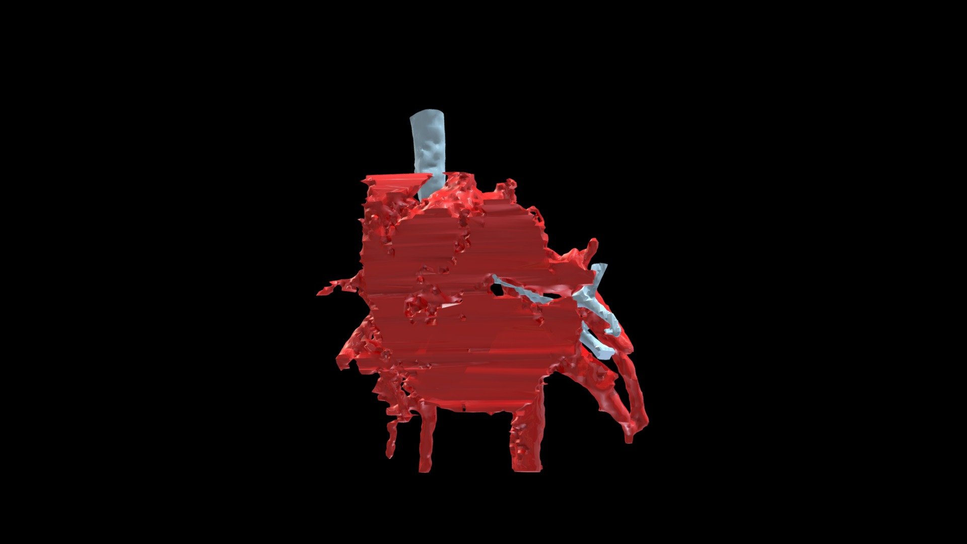 Left main bronchus narrowing - 3D model by Lincoln Wong (@lincolnwong ...
