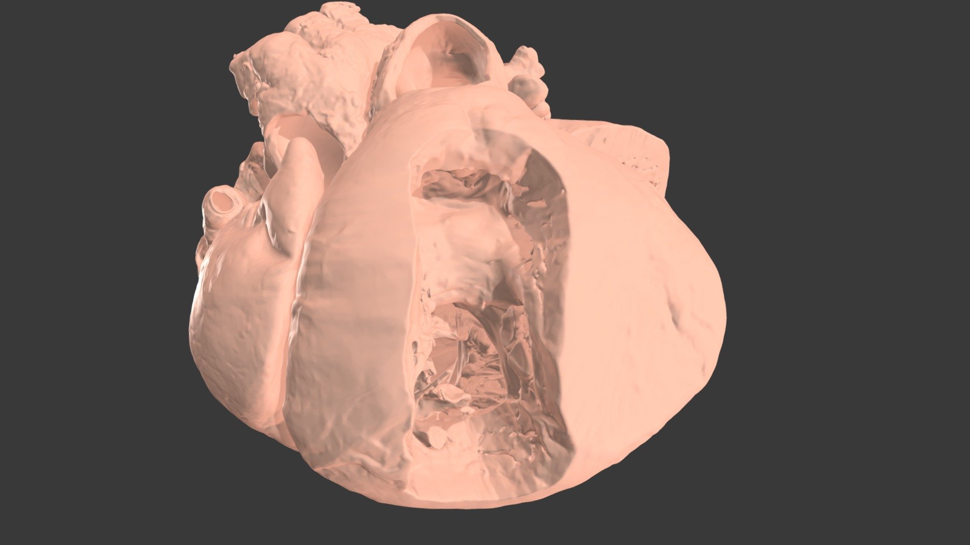 VSD #6 - T18, {S,D,S} with conoventricular VSD - 3D model by ...