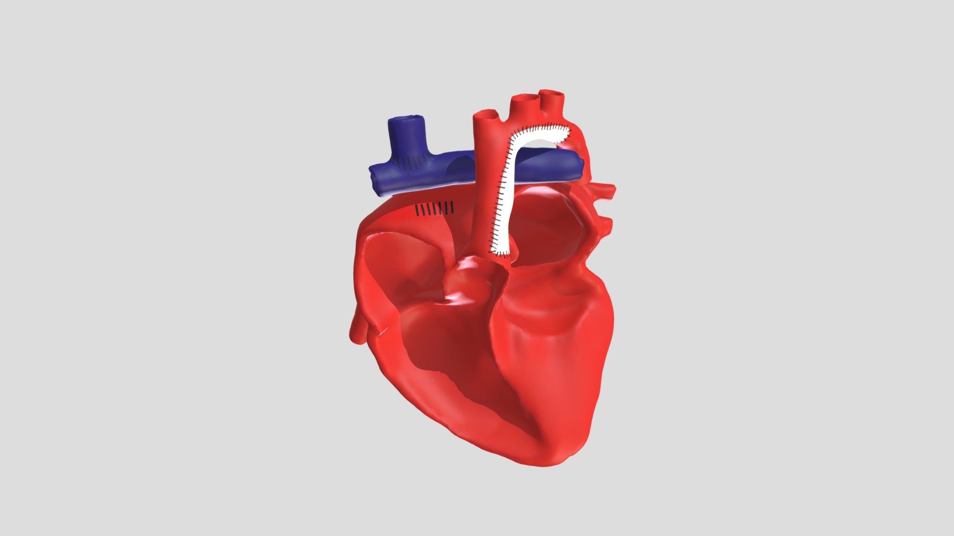 Post Hemi-Fontan Heart Surgery - 3D model by bmers [addb598] - Sketchfab