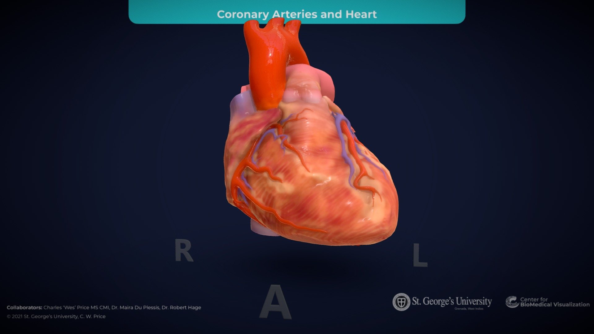 Coronary Arteries - 3D model by The Center for BioMedical Visualization ...