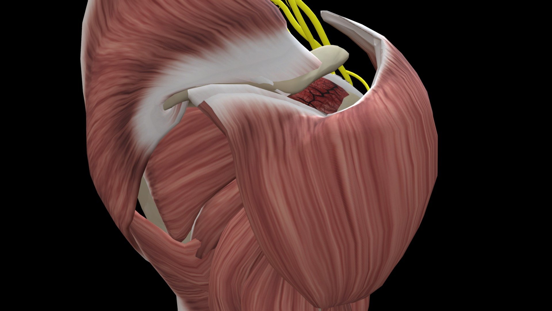 Torn Rotator Cuff Supraspinatus Rupture - 3D model by IU Indianapolis ...