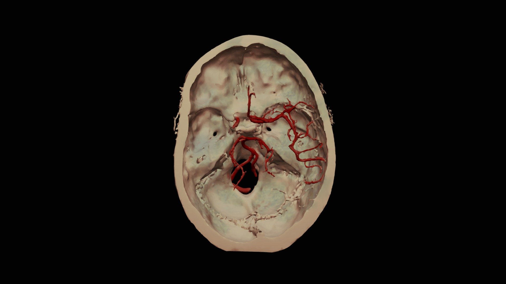 Occluded LT Distal ICA - 3D model by tl0615 [af6ade3] - Sketchfab