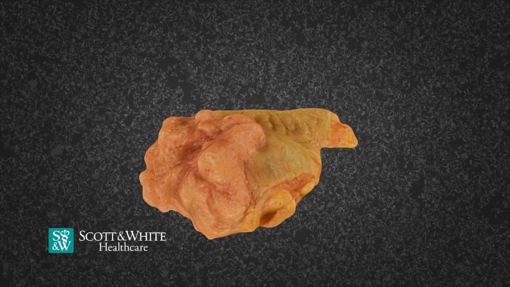 Sigmoid Precancerous Polyp 105744 - 3D model by Scott & White Moulage ...