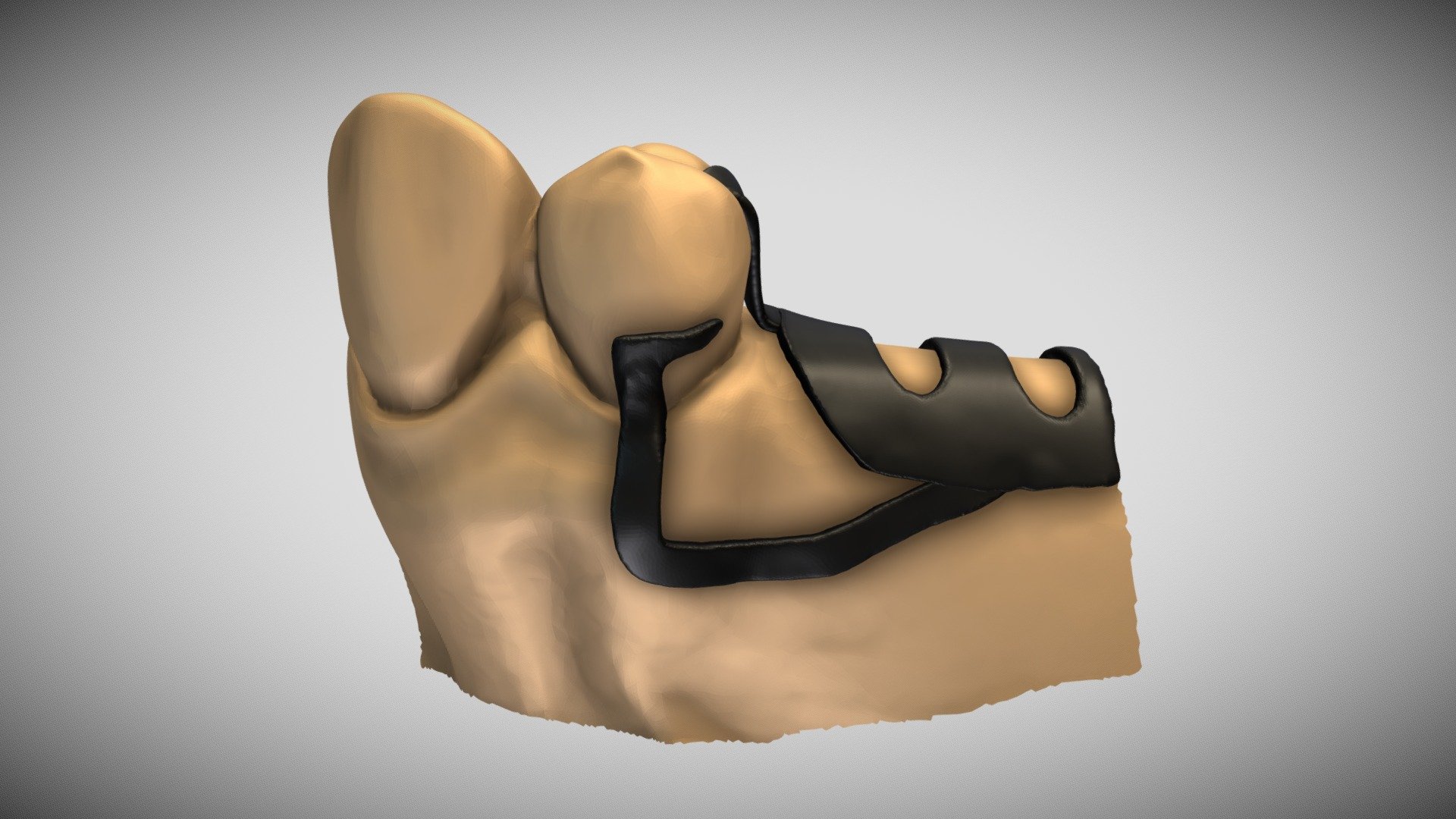 Modified T-Clasp - Download Free 3D model by Muhammad Nabeel ...