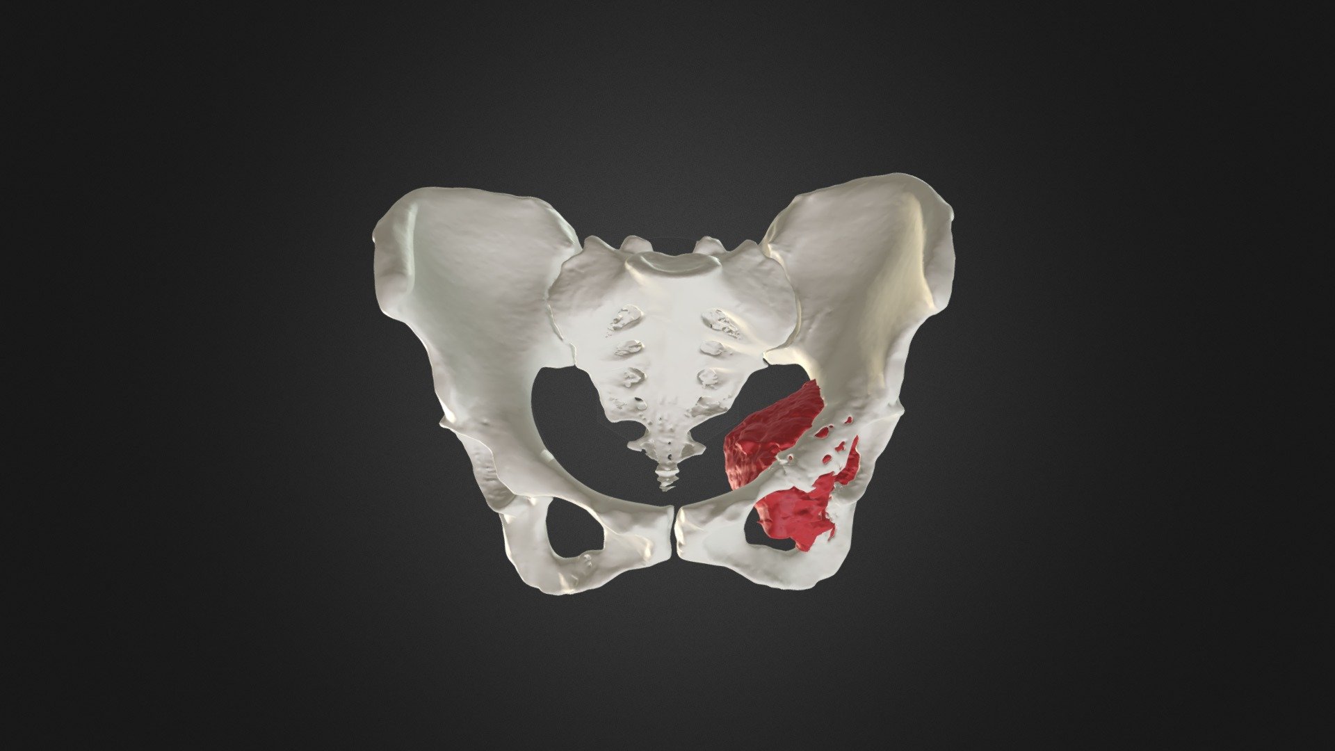 Giant Cell Tumor - 3D model by yuhuihuang [b14ae40] - Sketchfab