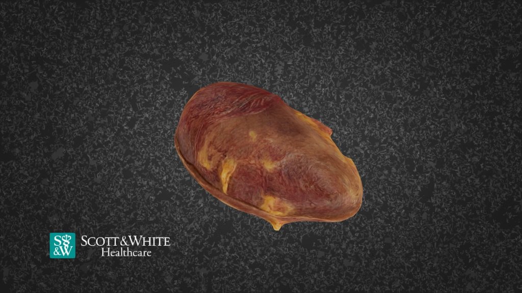 Kidney- Left, Chronic Pyelitis 125971 - 3D model by Scott & White ...