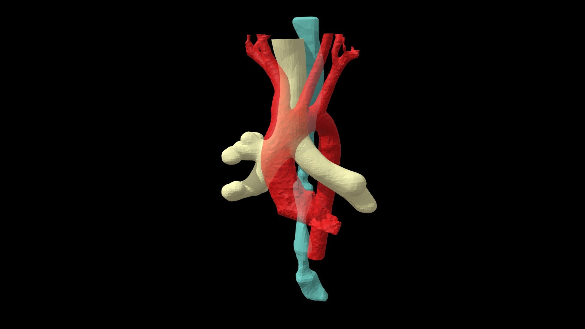 tracheal compression by innominate artery - 3D model by Lincoln Wong ...