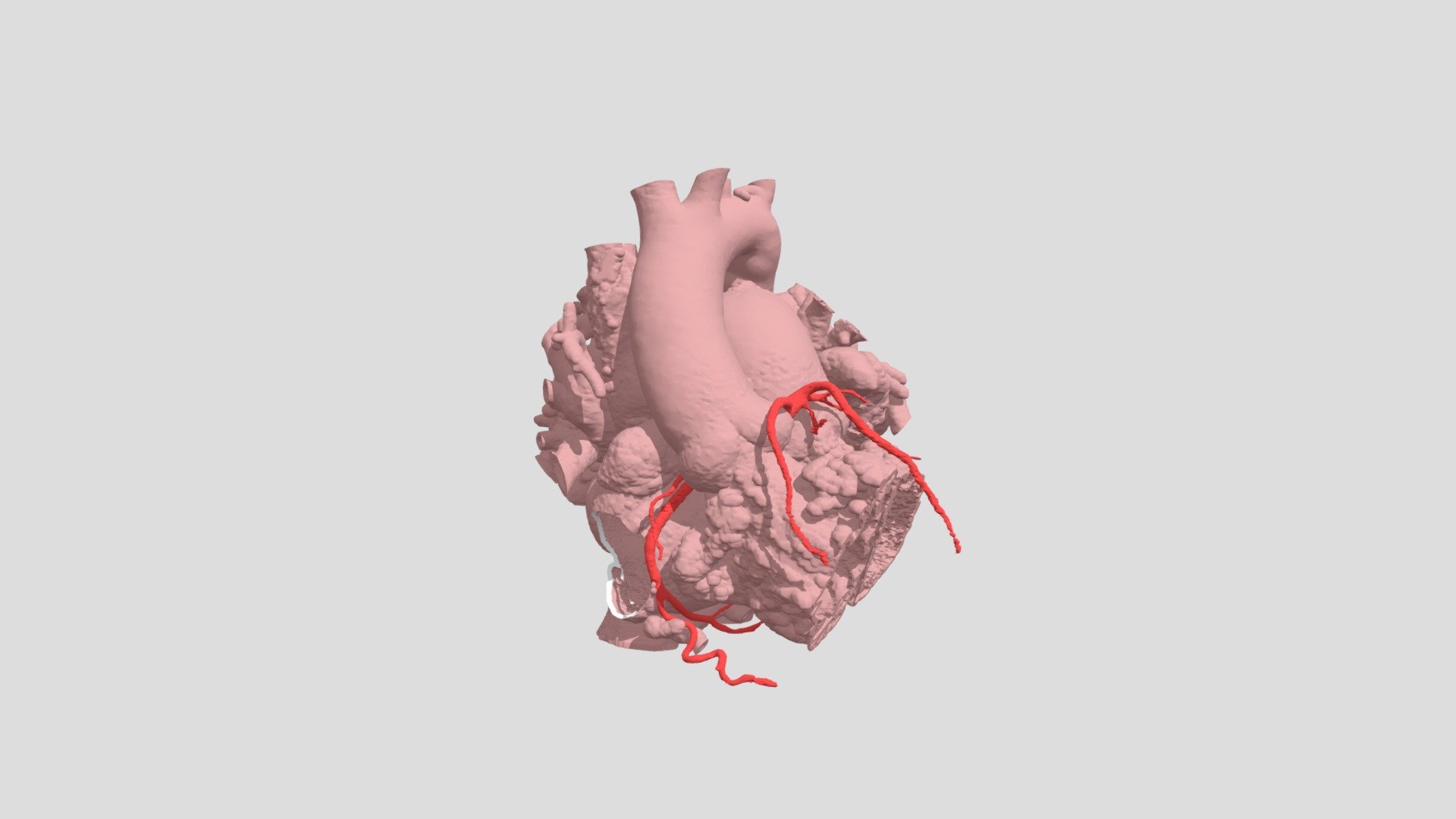 Dextro-Transposition of Great Arteries (H0288) - 3D model by NCHS ...