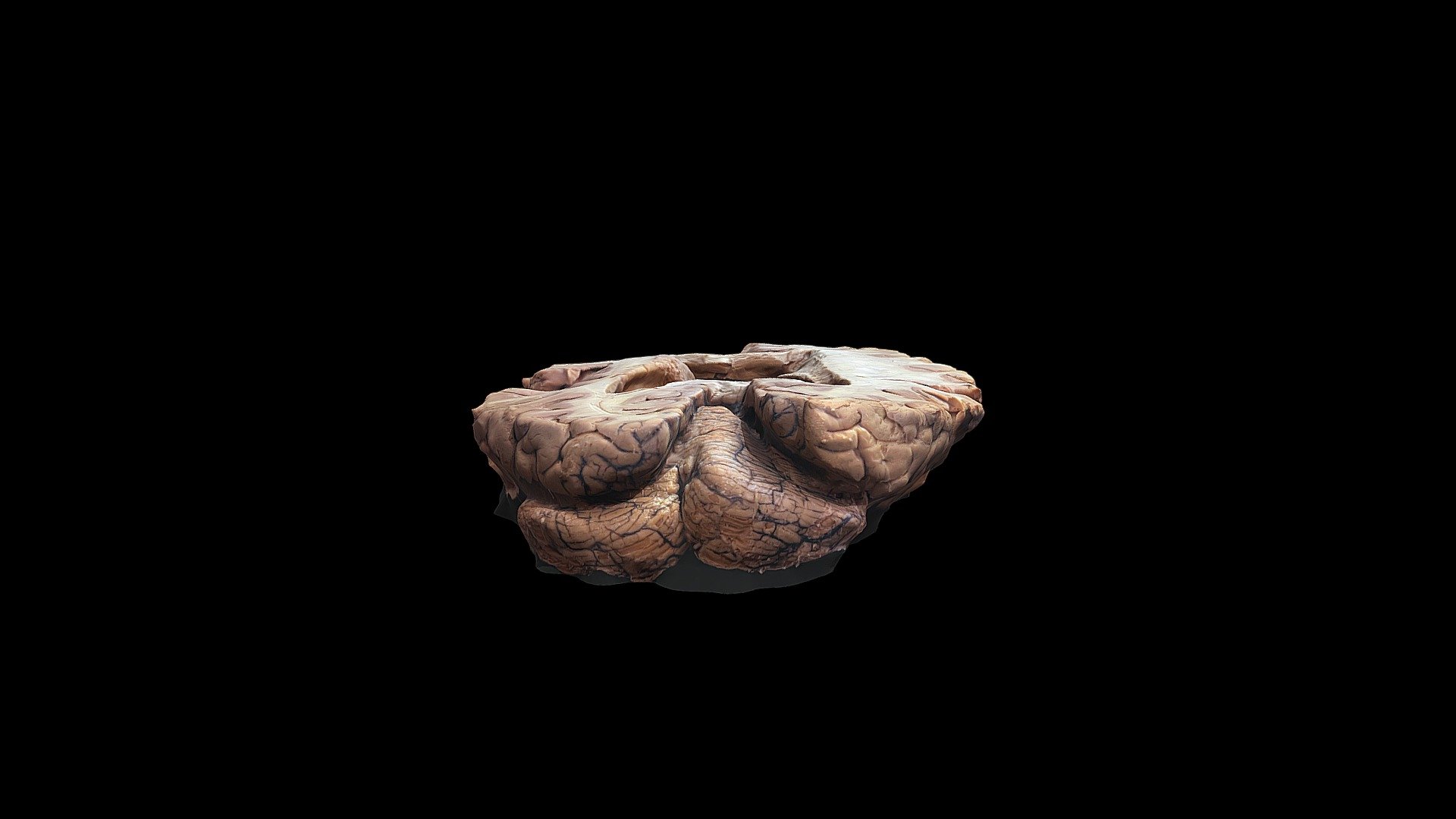 Bilateral Subthalamic Nucleus - 3D model by Istanbul-Microneurosurgery ...