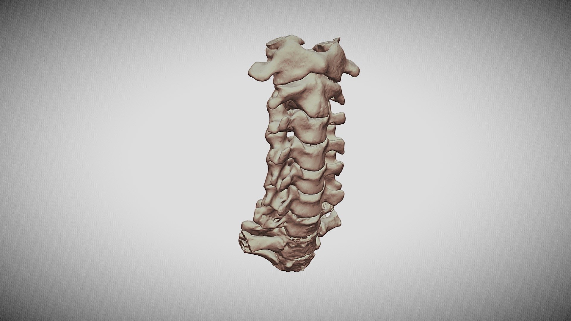 AOspine_Subaxial_TypeA1_C7 - 3D model by E_Schulz [b35660d] - Sketchfab