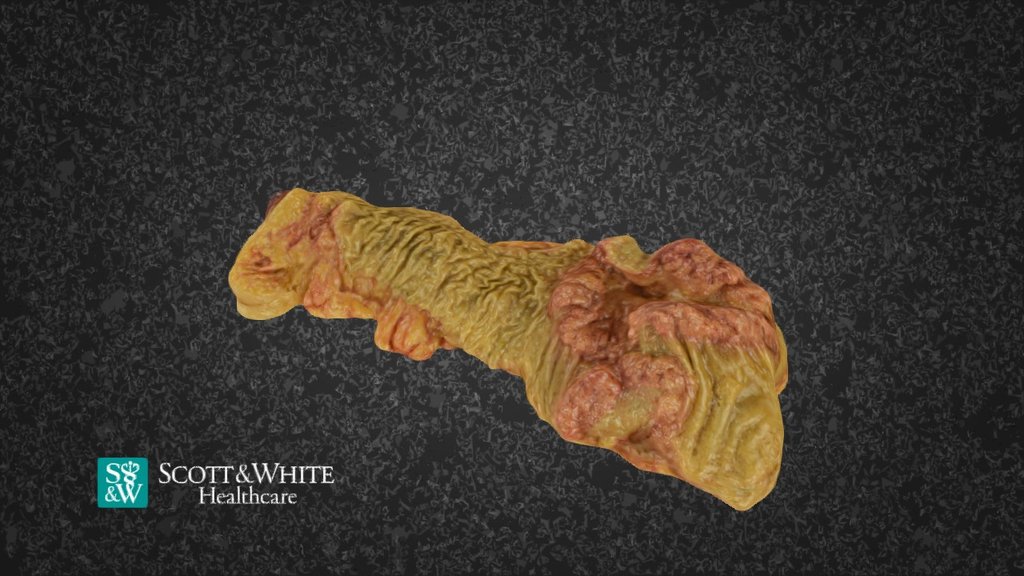 Rectosigmoid Adenocarcinoma 128789 - 3D model by Scott & White Moulage ...