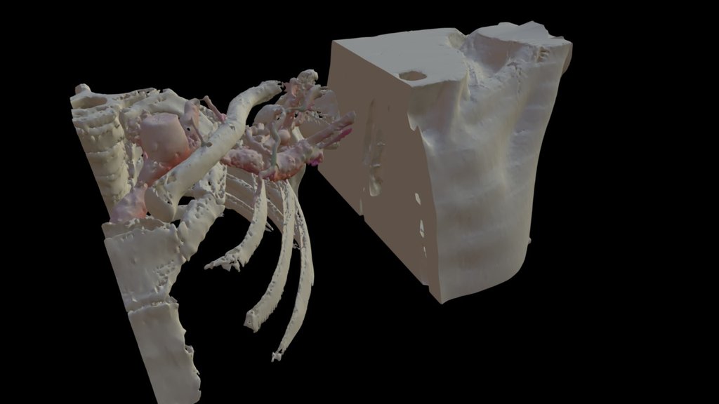# 049 Tumor - 3D model by makerof3d [b4152be] - Sketchfab