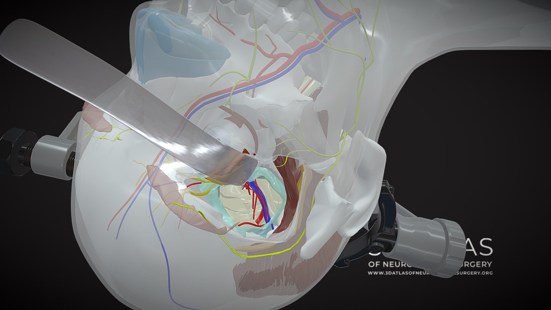 Lateral orbital approach - 3D model by 3D Atlas of Neurological Surgery ...