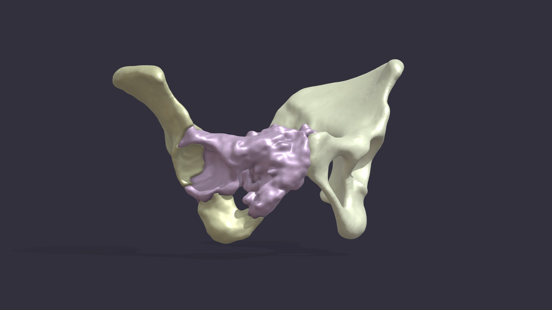3D Model of Pelvic Tumor - 3D model by drzaju [b51cdbc] - Sketchfab