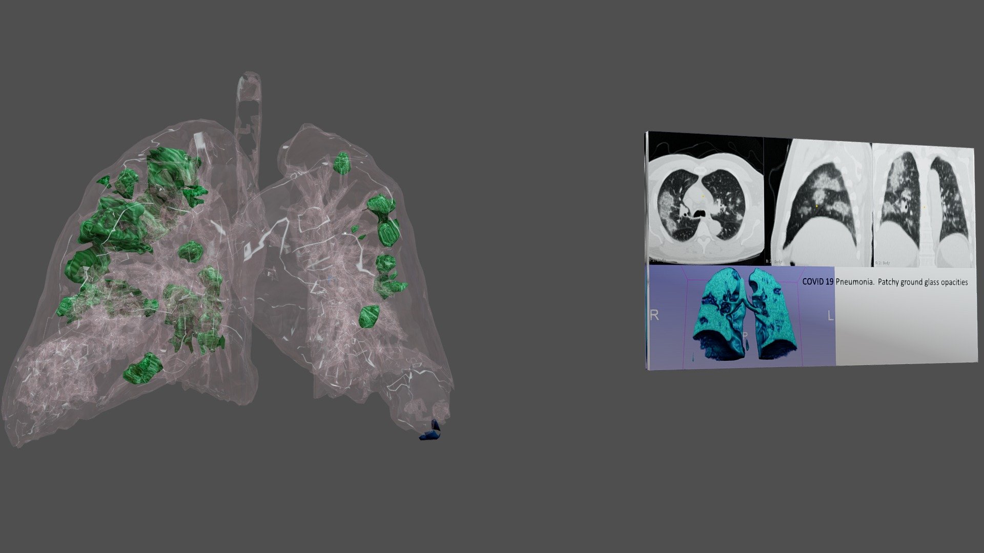 Coronavirus COVID 19 Pneumonia CT - Download Free 3D model by tl0615 ...