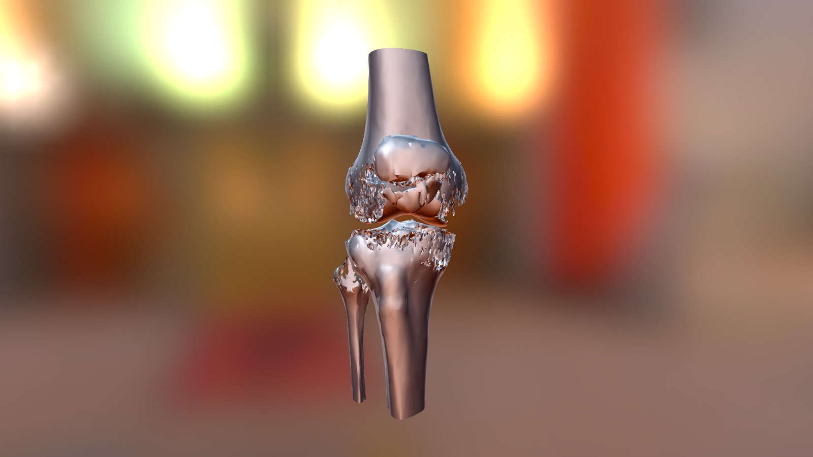 Knee - Patella Fracture sku 066 - 3D model by orto3d [b5cce52] - Sketchfab