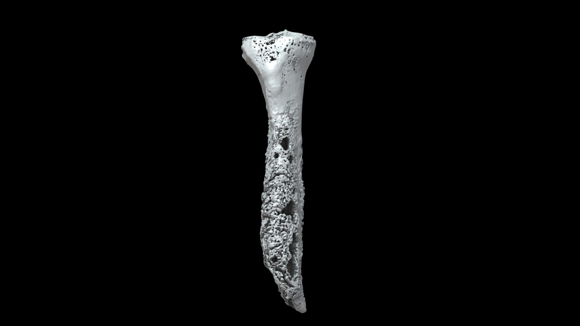 Right Tibia with Osteomyelitis (VCU_3D_5400) - 3D model by Virtual ...
