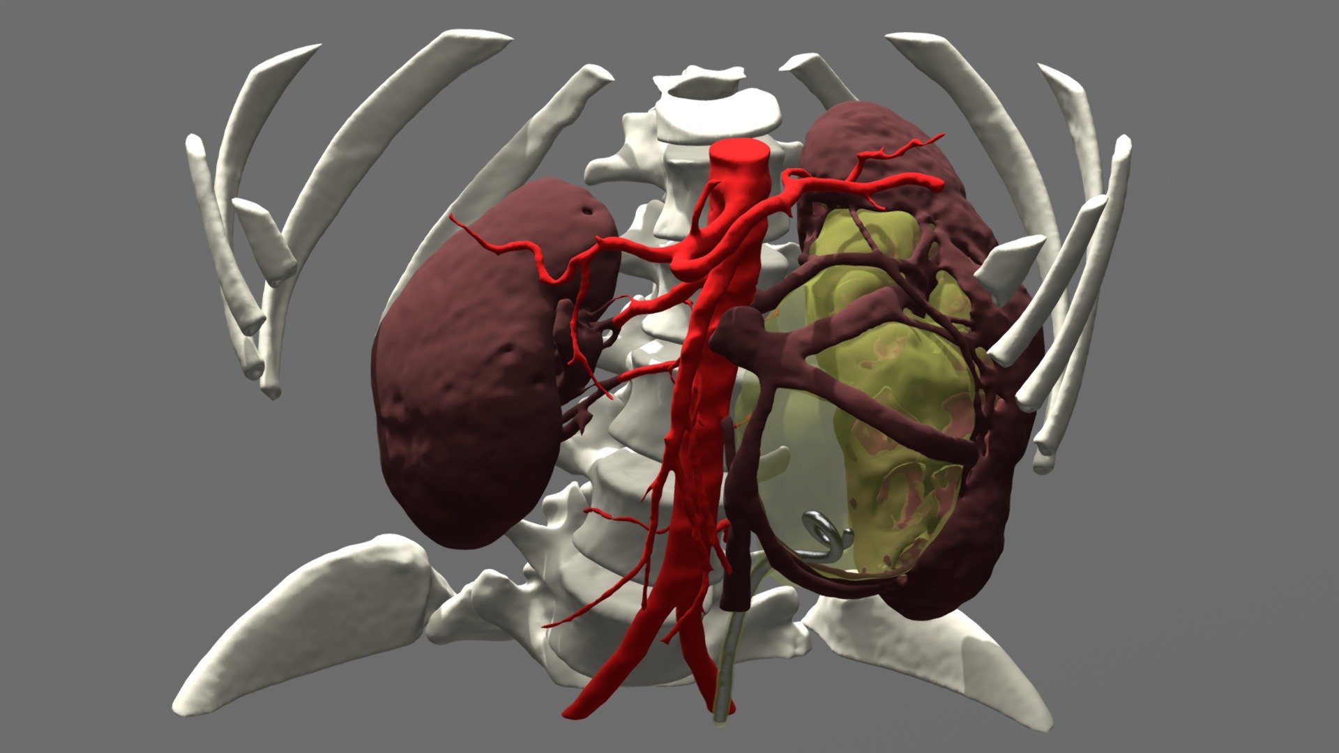 Left Hydronephrosis with Ureteral Stent - 3D model by valchanov ...