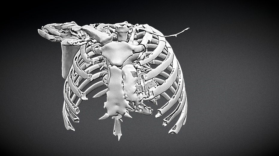 CT SCAN OF CHEST AREA - 3D model by aabernethy [b7ebcf9] - Sketchfab