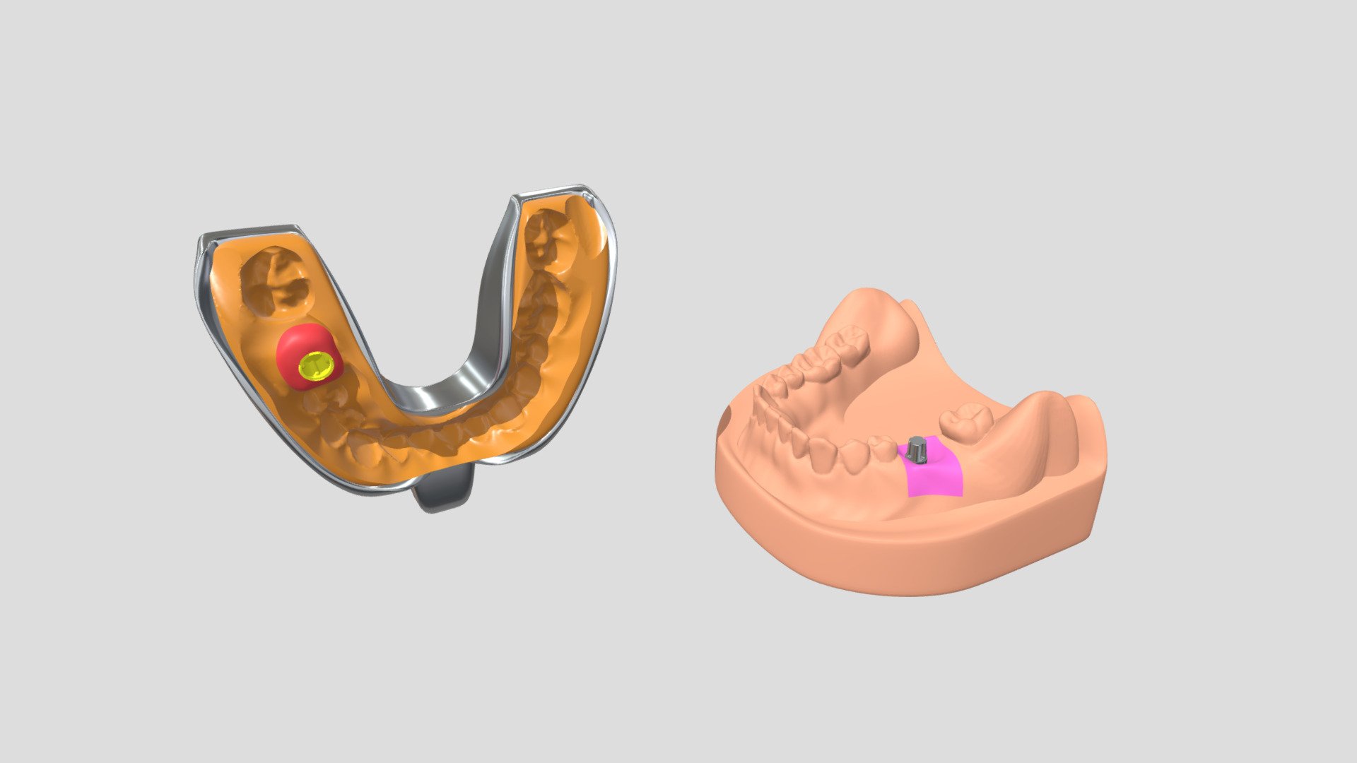 Working cast - closed tray technique - 3D model by Mateus Bertolini ...