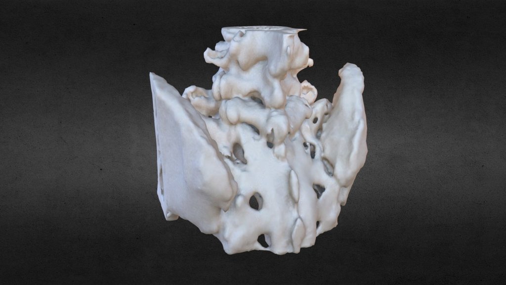 Pelvic Exenteration - 3D model by RPA IAS (@kai.cheng) [b960e2b ...