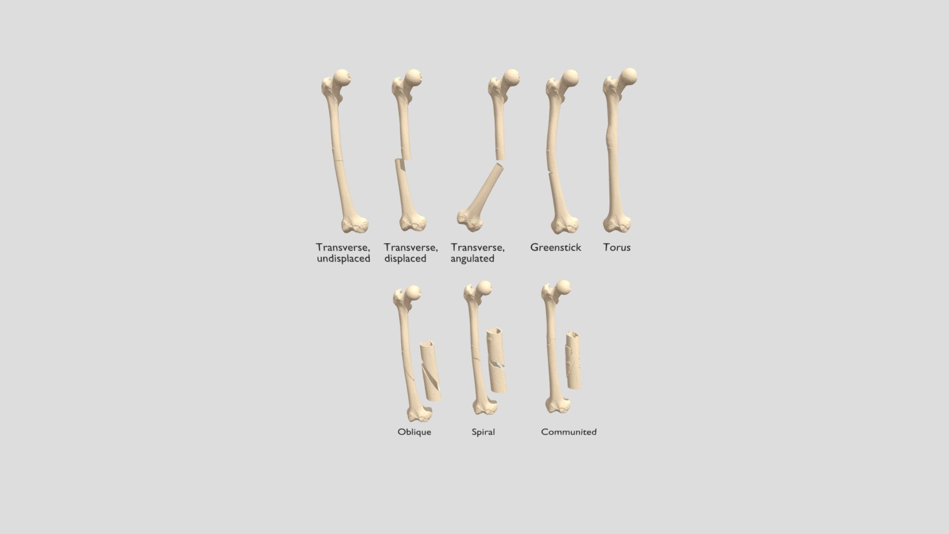 Types of fractures - 3D model by VivekAnatomy [b98ef27] - Sketchfab