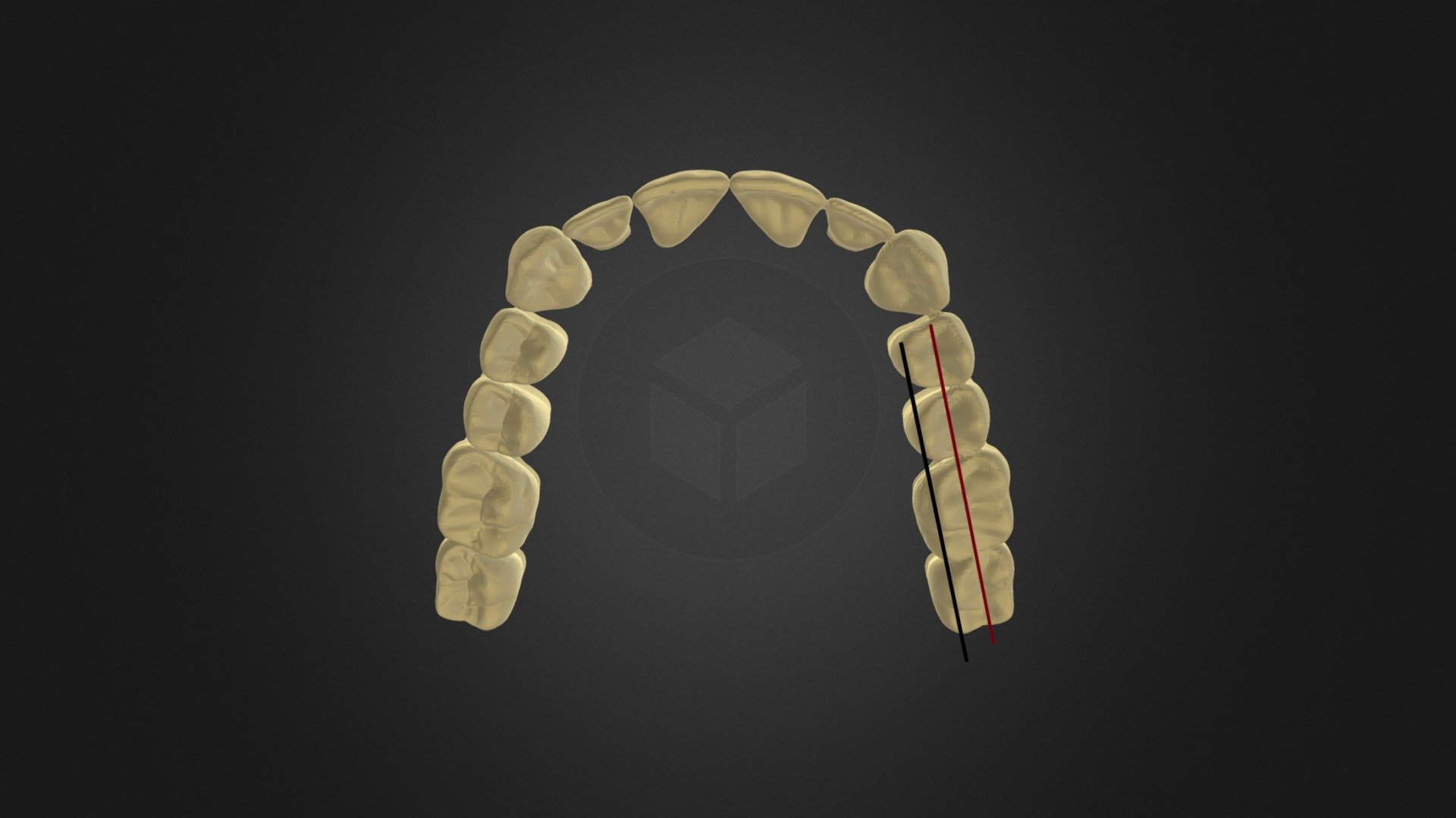3_upper teeth alignment - 3D model by bsupanee [ba21795] - Sketchfab