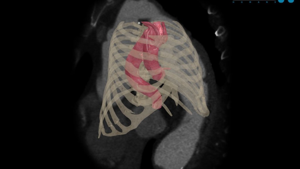 HumanX - TAA thoracic aortic aneurysm - 3D model by HumanX Medical ...