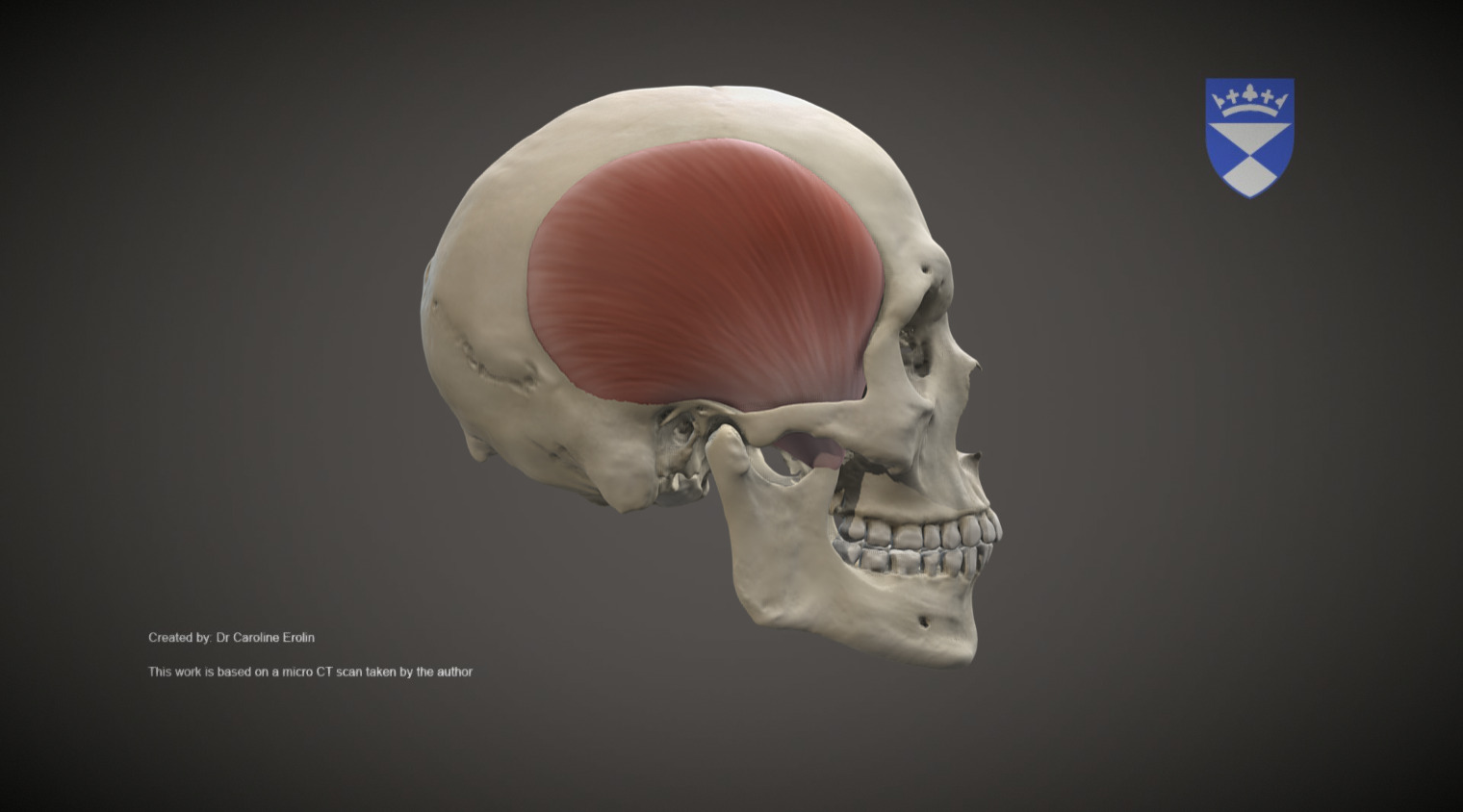 Temporalis muscles - 3D model by University of Dundee, CAHID (@anatomy ...