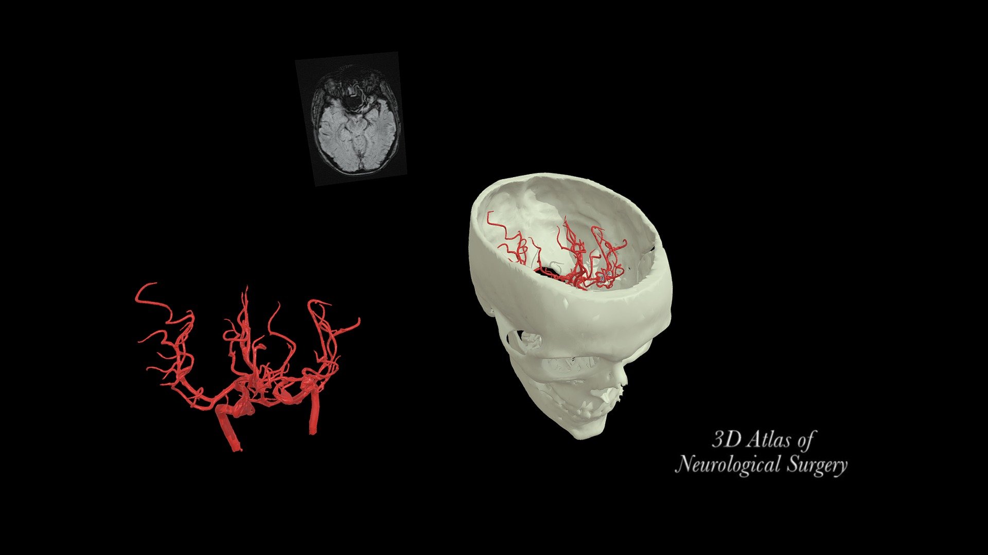 Left MCA aneurysm - 3D model by 3D Atlas of Neurological Surgery ...